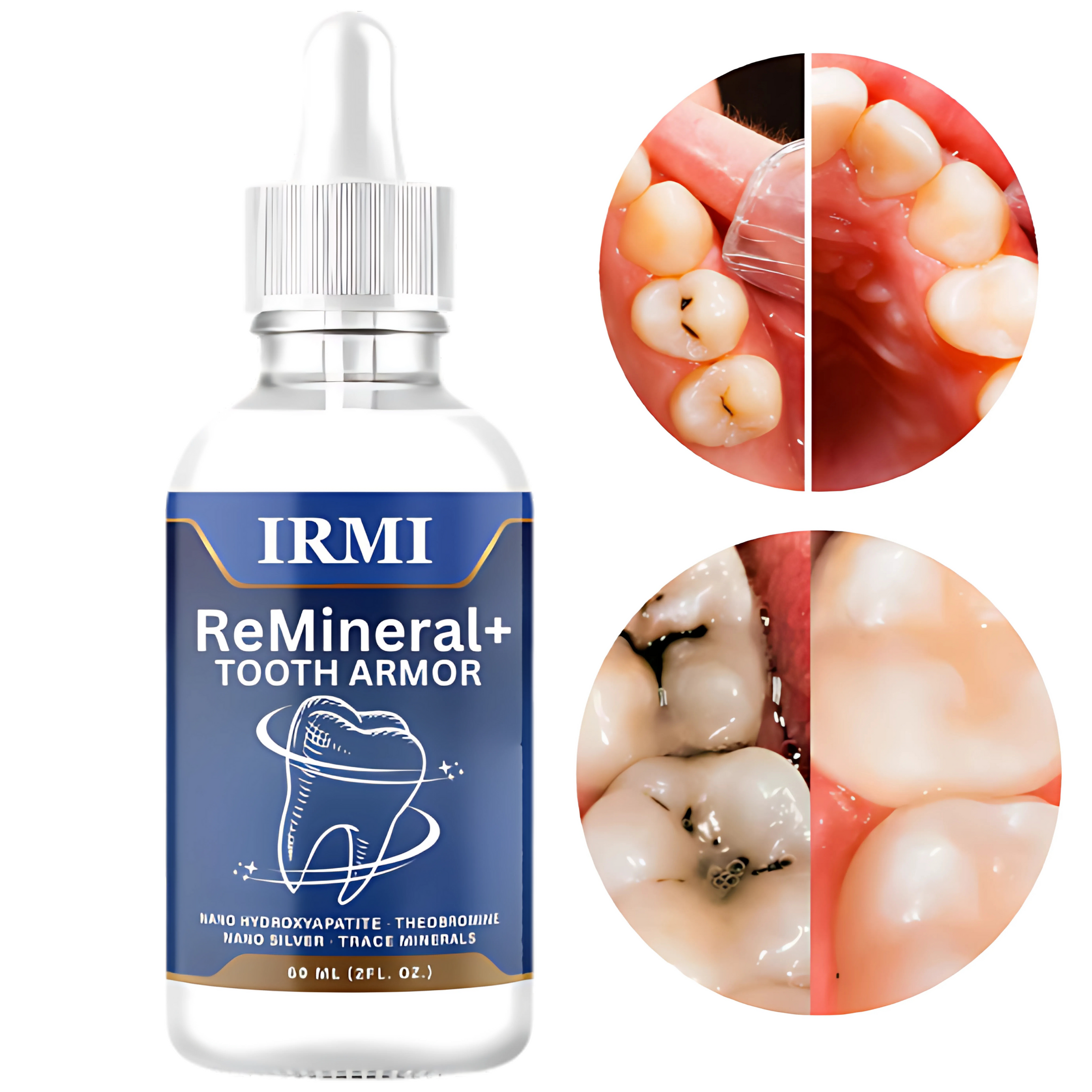 Advanced Tooth Armor Dentite – Irmi